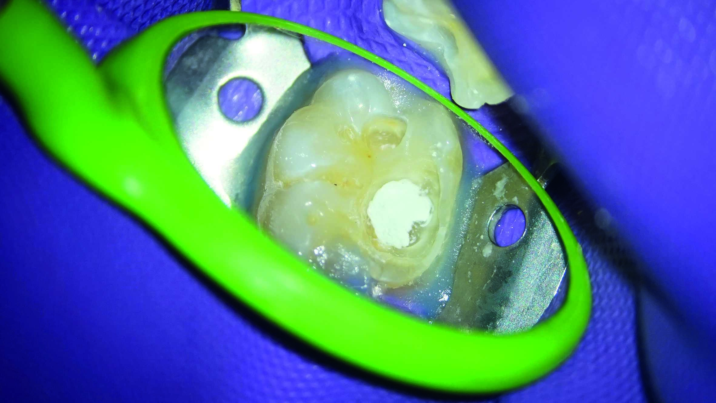 Dental News - Direct pulp capping as a conservative procedure to ...