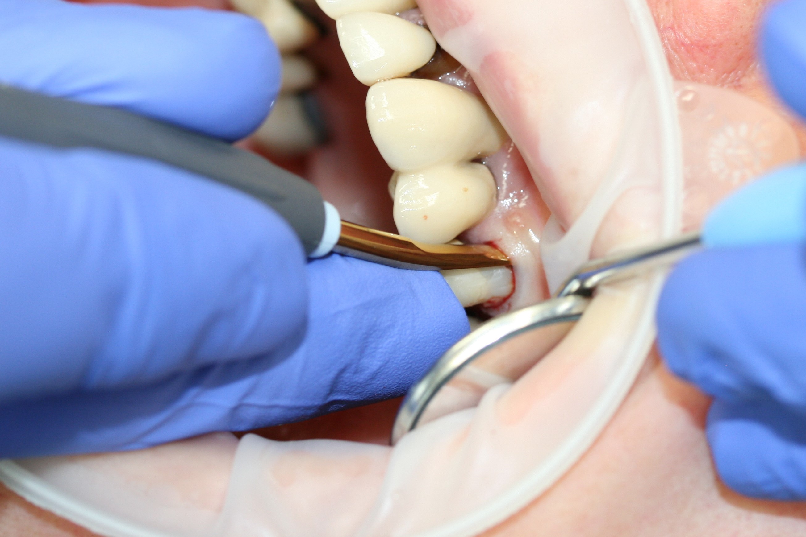 Atraumatic extraction of maxillary second premolar
