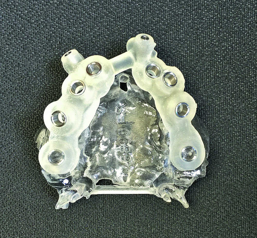 CFAO pour restaurations complètes sur implant