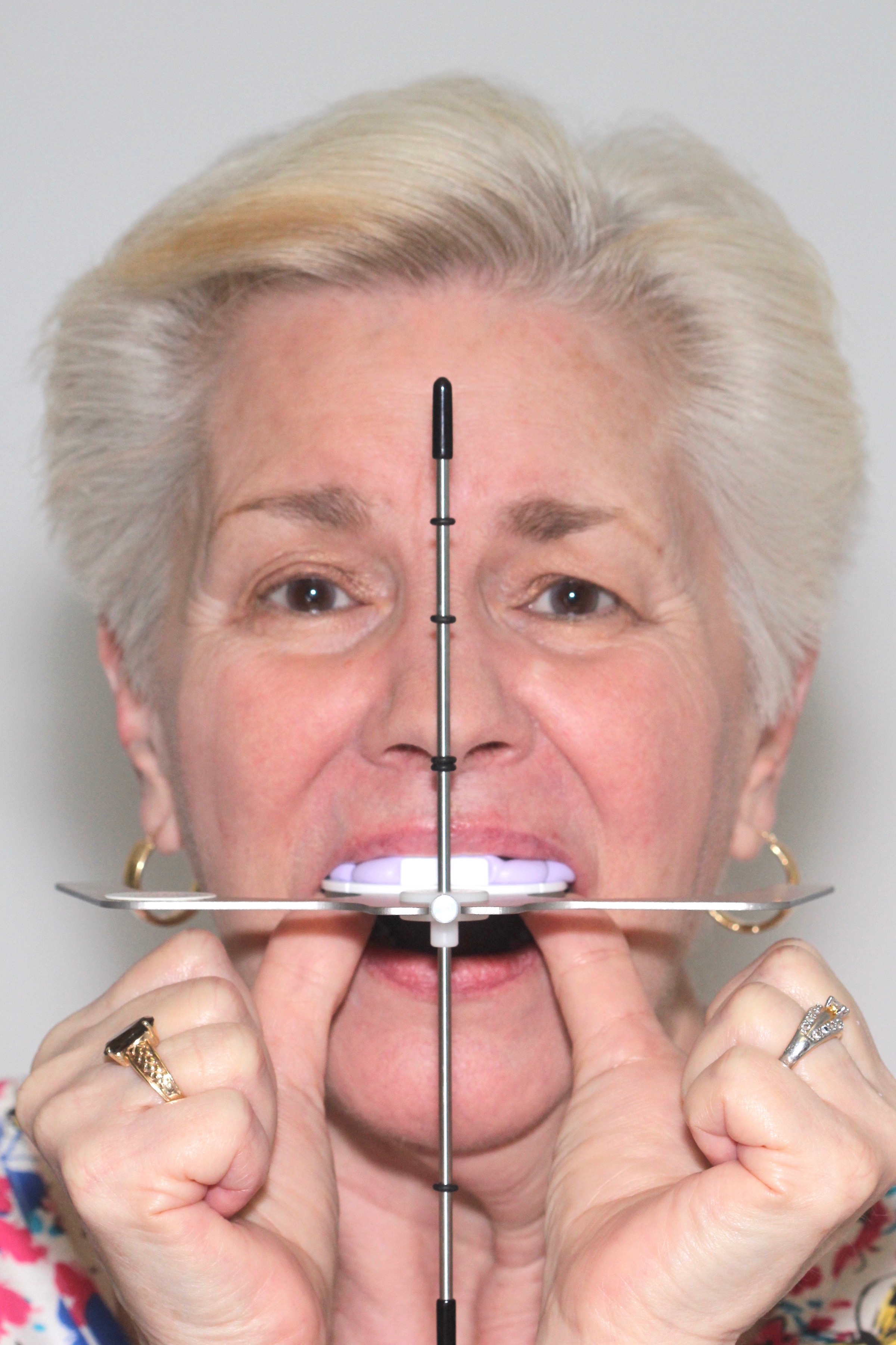 Dental News - Digital face-bow transfer technique dentofacial analyser ...