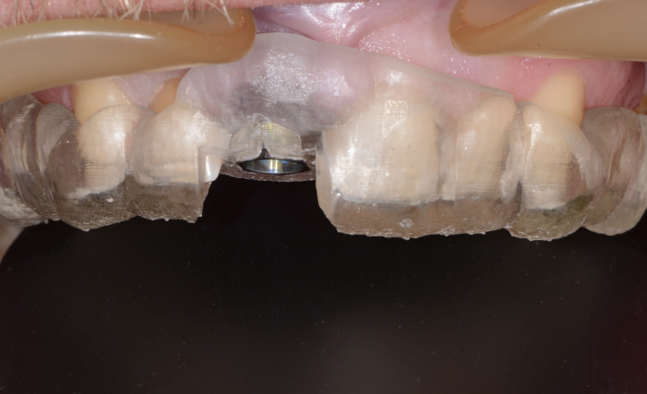 Dental News - The use of new technologies and digital implant solutions ...