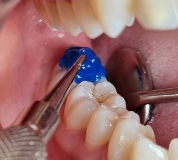 The stamp technique: Quick and effective restoration with glass hybrids